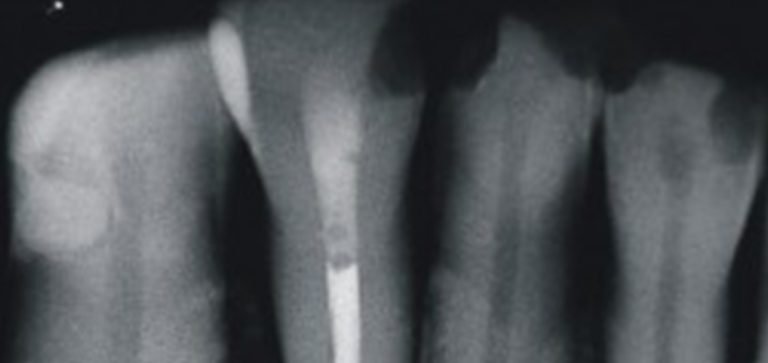 Vertical Root Fracture | PhD. MSc. DMD. Pablo Salmeron, Endodontist in ...