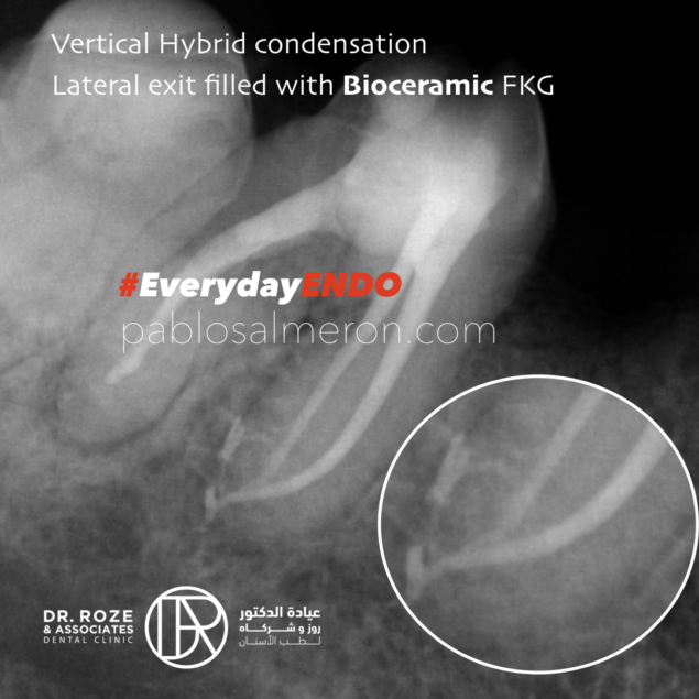 Lateral exit filled with bioceramics | Dr. Pablo Salmeron | Consultant ...