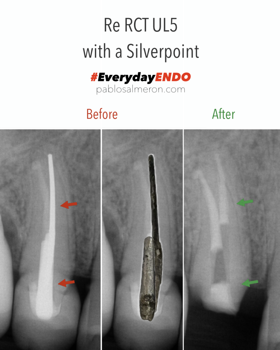 Removal of silver points | Dr. Pablo Salmeron | Consultant Endodontist ...