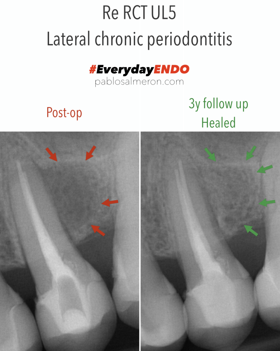 Lateral chronic periodontitis | PhD. MSc. DMD. Pablo Salmeron ...