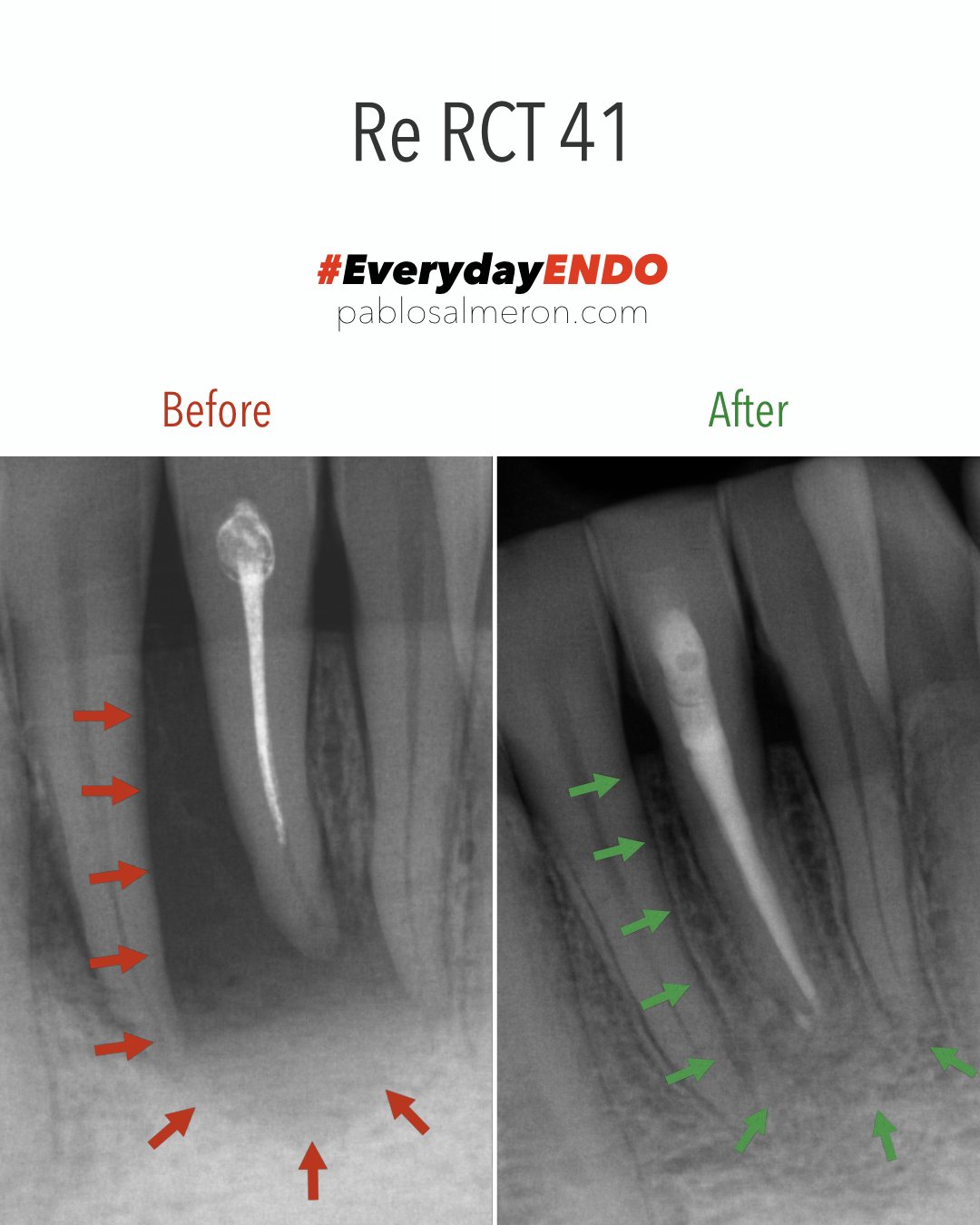 Big chronic apical periodontitis on a lower incisor | Dr. Pablo ...